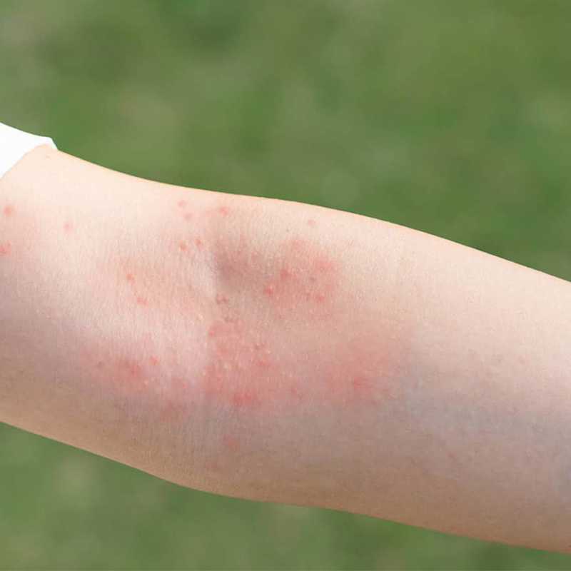 Can Silicone Cause Allergies? Myths and Realities Explained | siliconedx